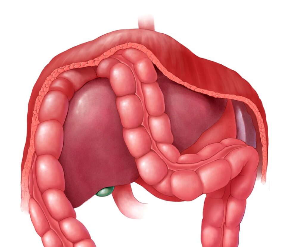 キライディティ症候群（Chilaiditi syndrome)